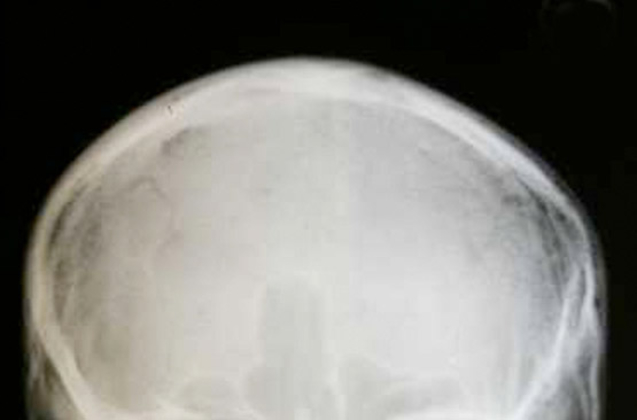 Traumatisme crânien - Planete sante