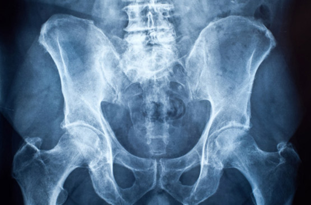 Tendances séculaires des fractures de hanche - Planete sante