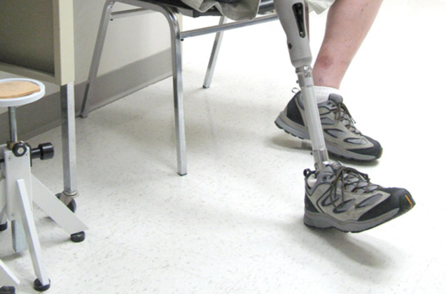 L'amputation - Planete sante