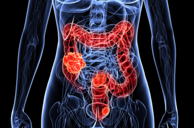 Cancer du côlon (carcinome rectal) - Planete sante