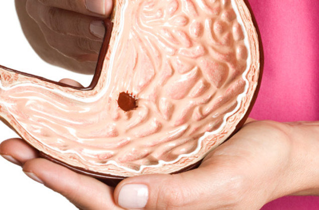 Ulcère gastroduodénal - Planete sante