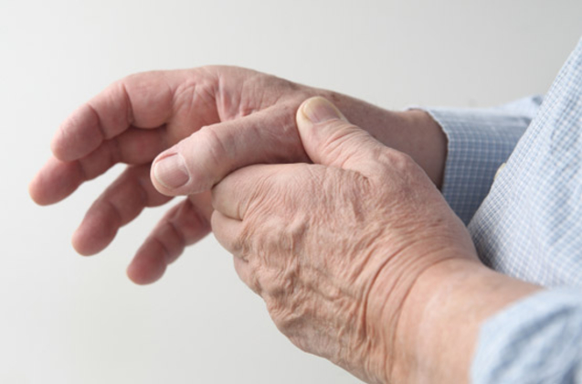 Polyarthrite rhumatoïde: quels facteurs de risque? - Planete sante