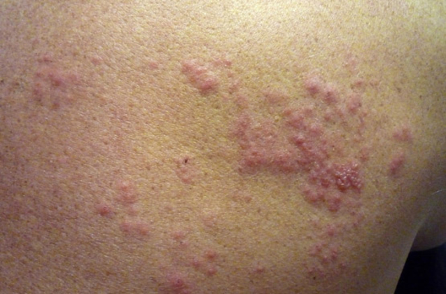 Le zona, c’est quoi? - Planete sante