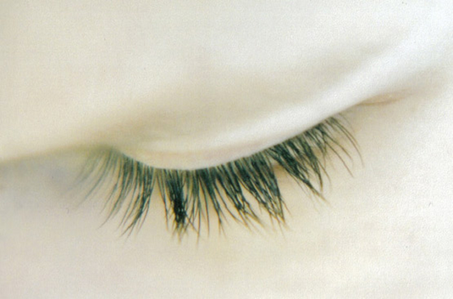 Conjonctivite - Planete sante